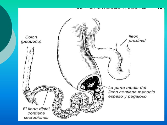 Ileo meconial