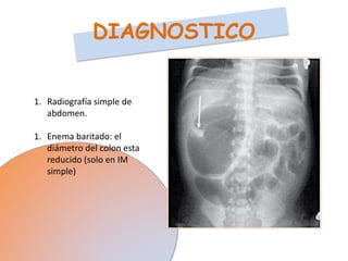 Ileo meconial | PPT
