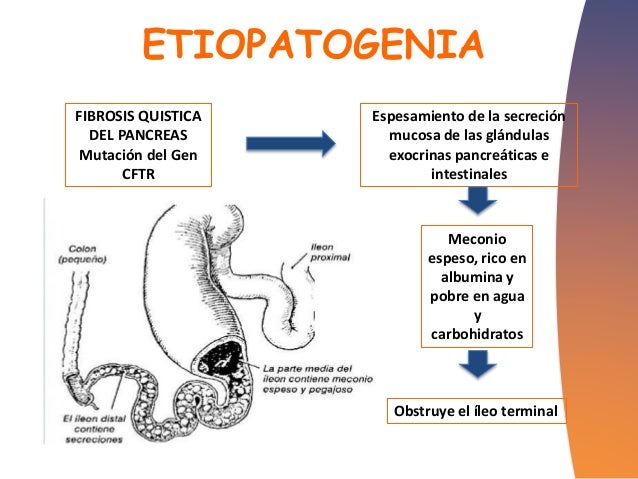 Ileo meconial