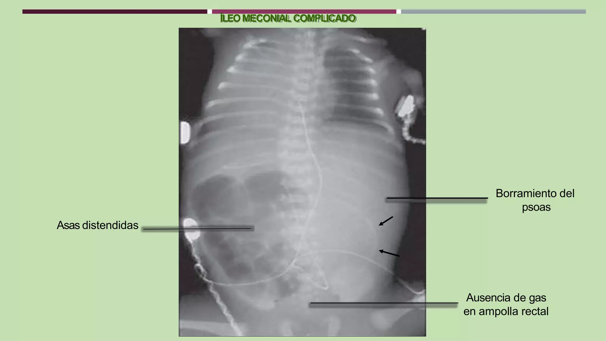 Ileo meconial | PPTX
