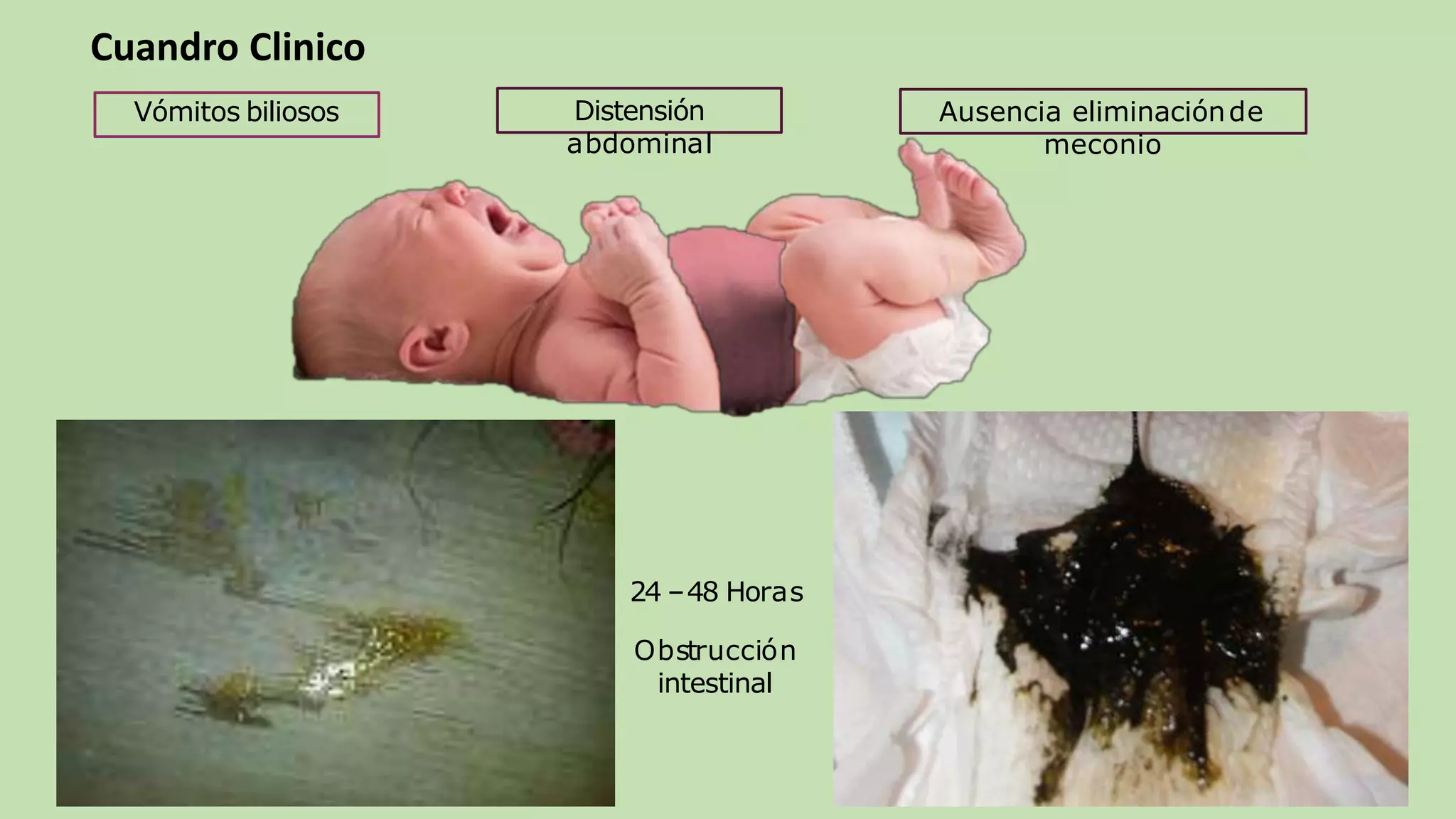 Ileo meconial | PPTX