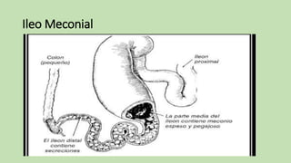 Ileo meconial | PPTX