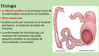 Ileo meconial | PPTX
