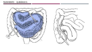 Ileo meconial | PPTX