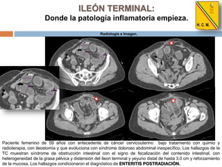 ILEÓN TERMINAL: | PPT