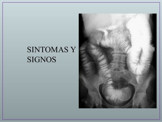 Ileo obstruccion intestinal
