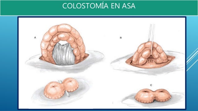Ileostomias y Colostomias