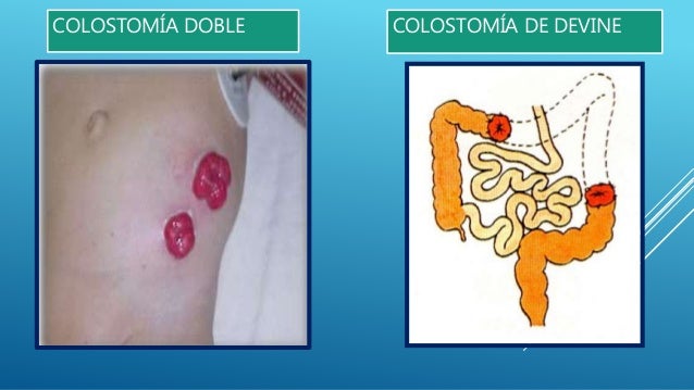 Ileostomias y Colostomias