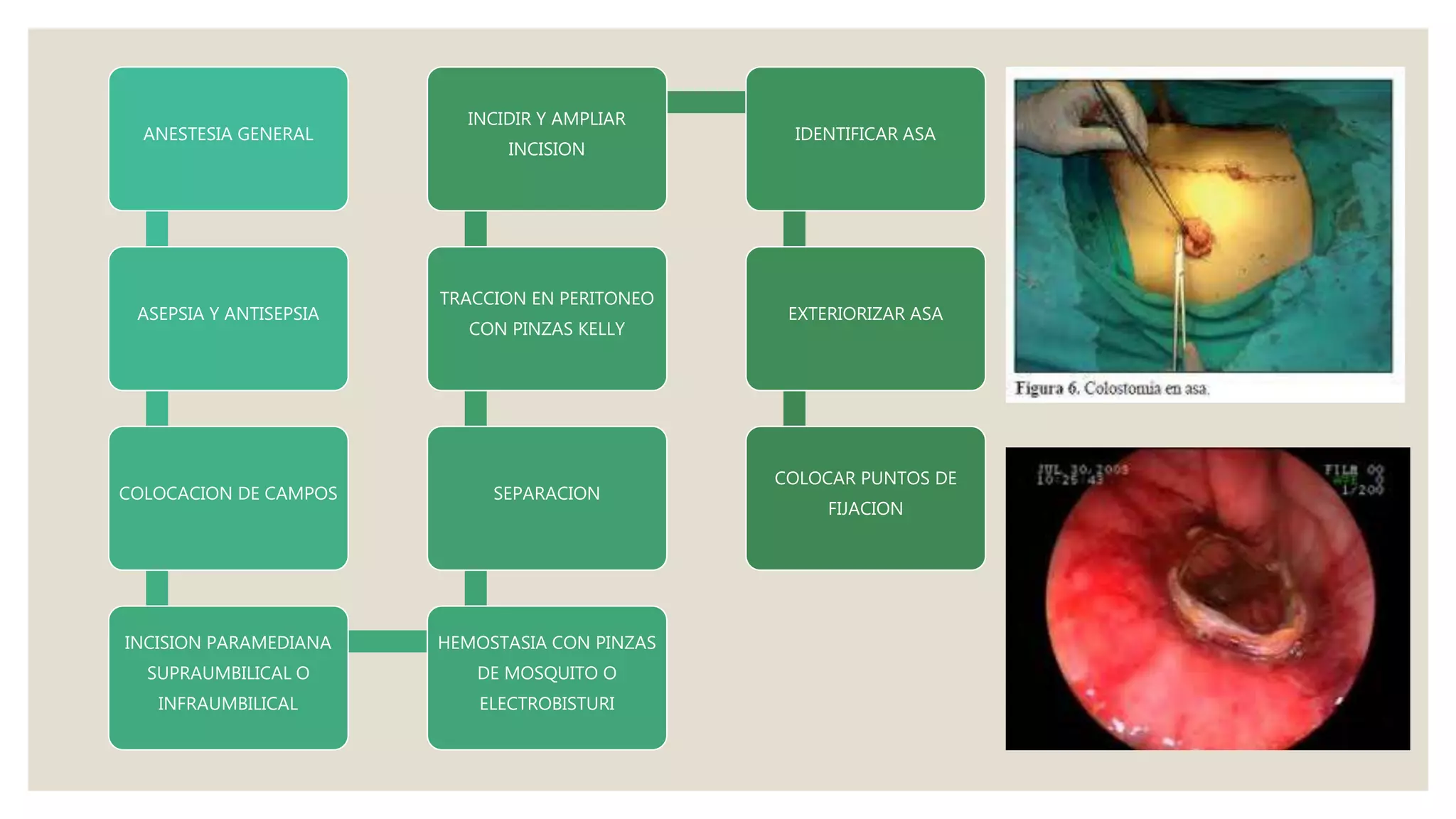 Ileostomía y colostomía | PPTX