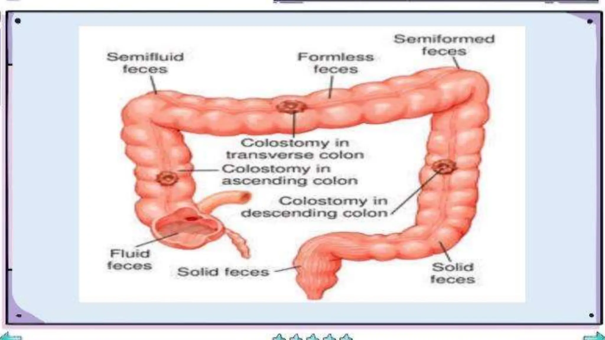 ileostom colostomy care and irrigation new1.pptx