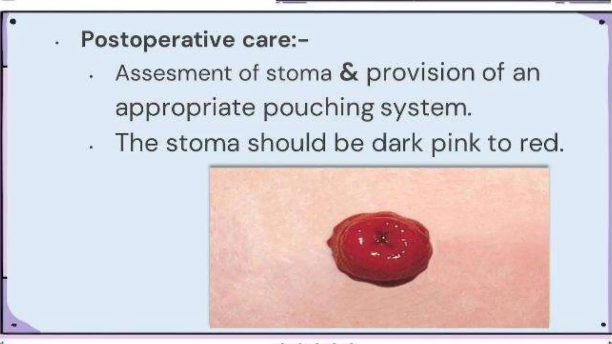 ileostom colostomy care and irrigation new1.pptx
