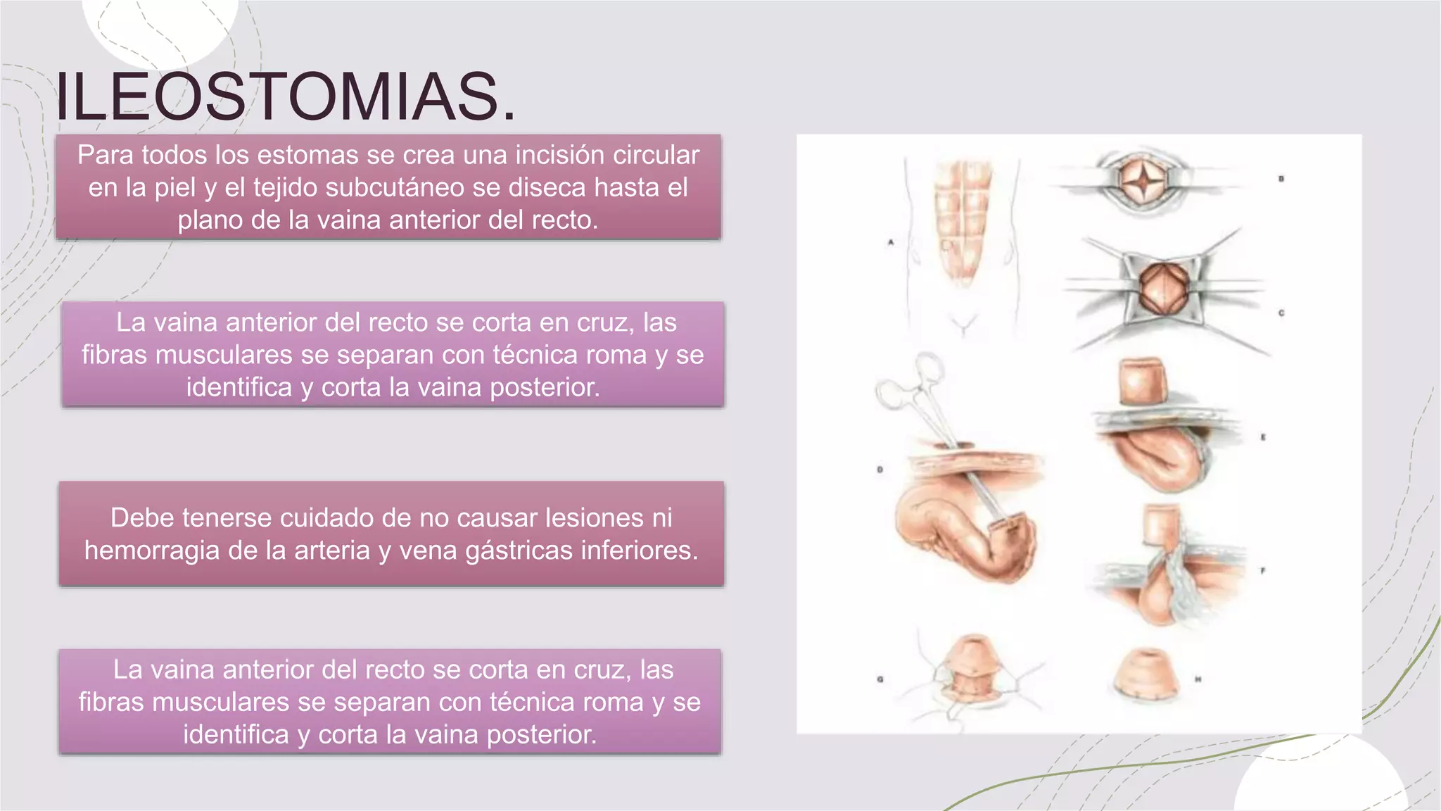 ileostomias.pptx