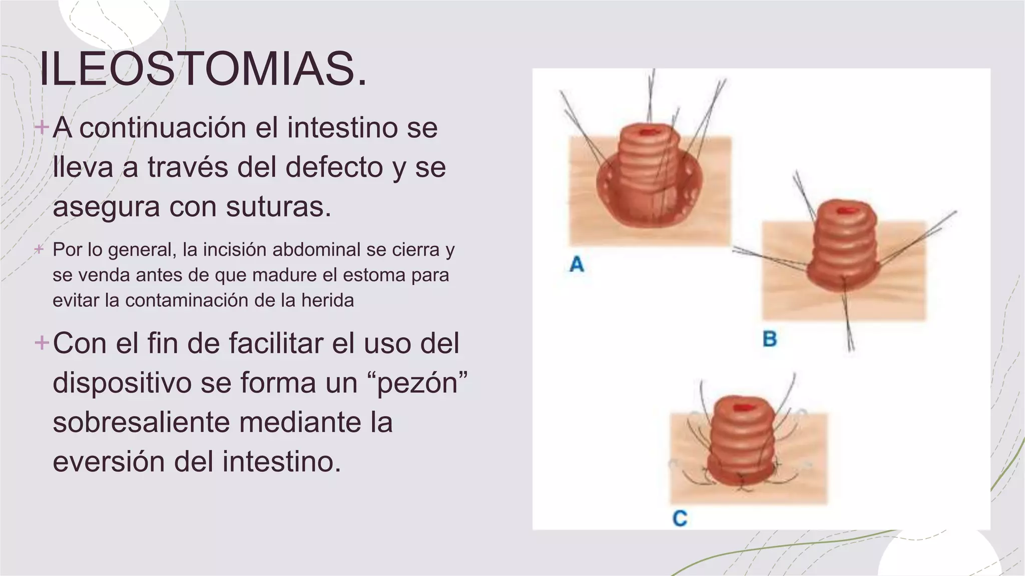 ileostomias.pptx