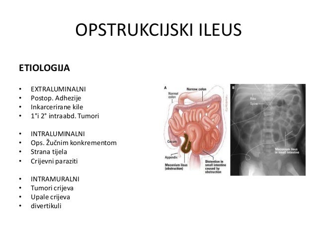 Ileus
