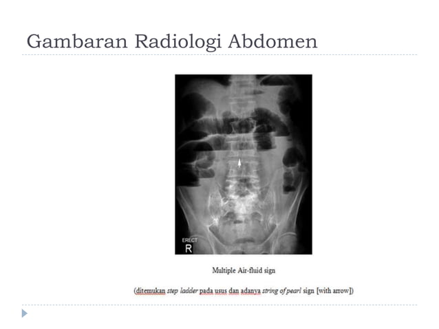 Ileus Obstruction-1.pptx