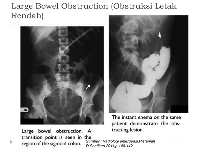 Ileus Obstruction-1.pptx
