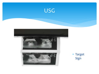 Ileus obstruction | PPTX