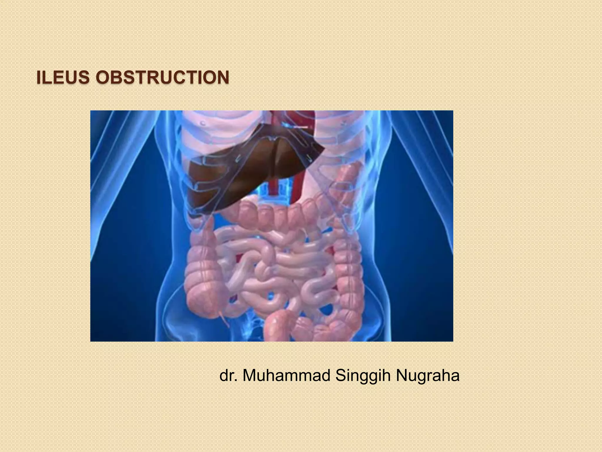 Ileus obstruktif | PPTX