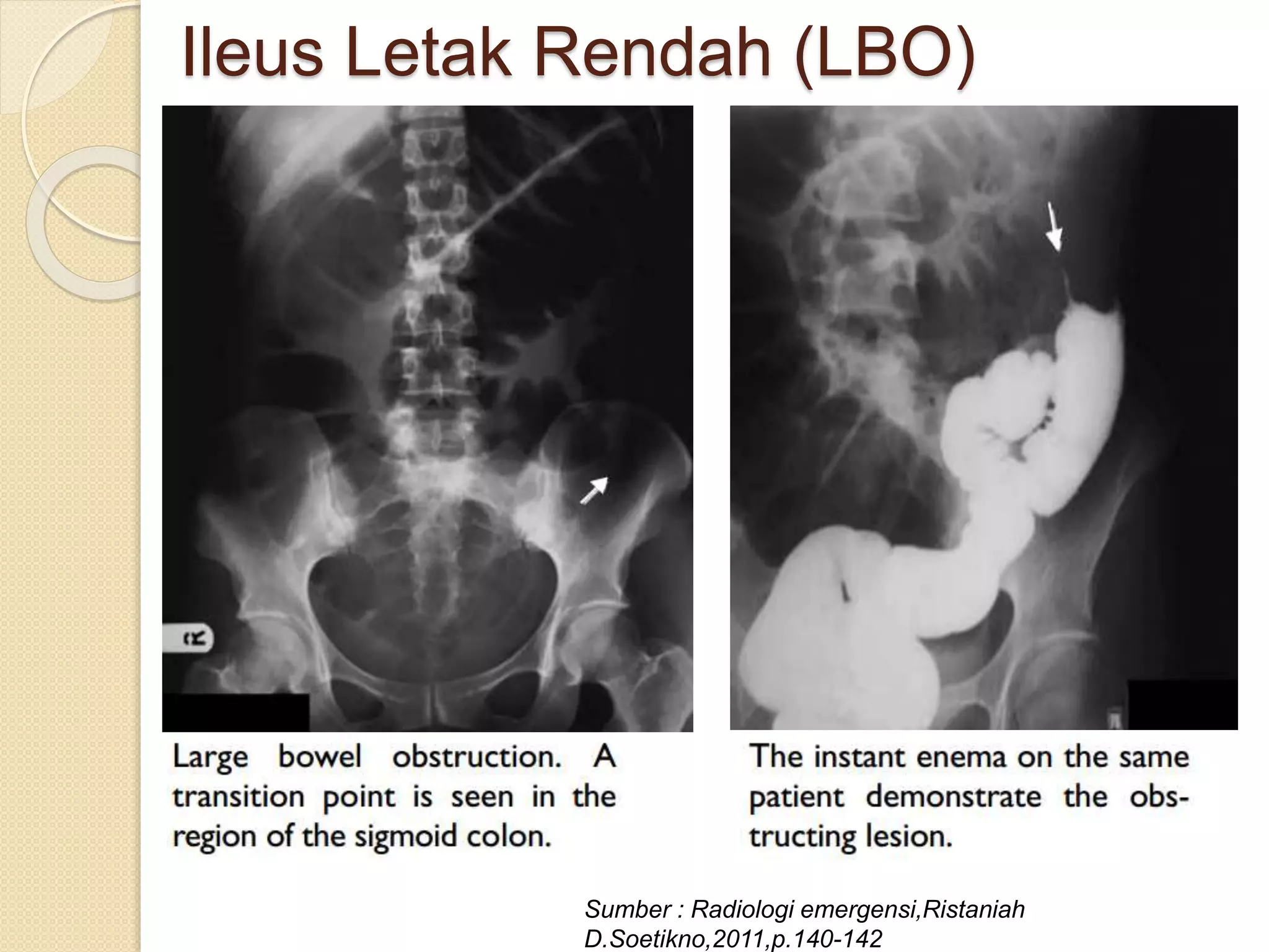 Ileus obstruktif | PPTX