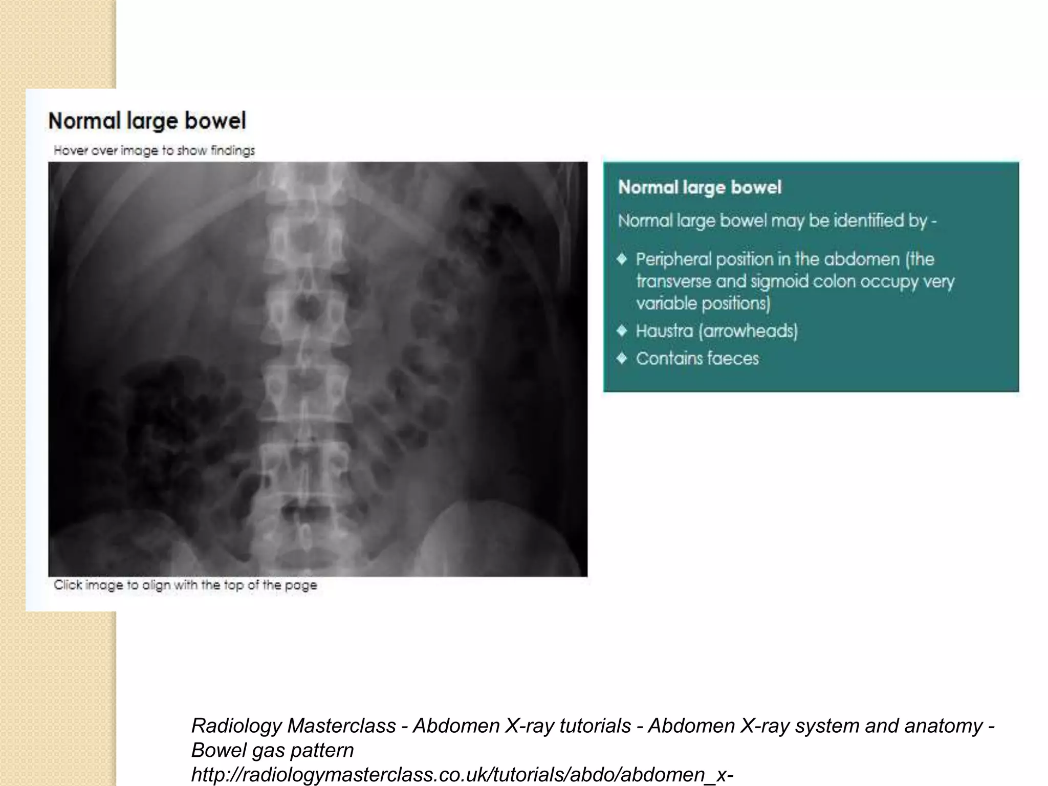 Ileus obstruktif | PPTX