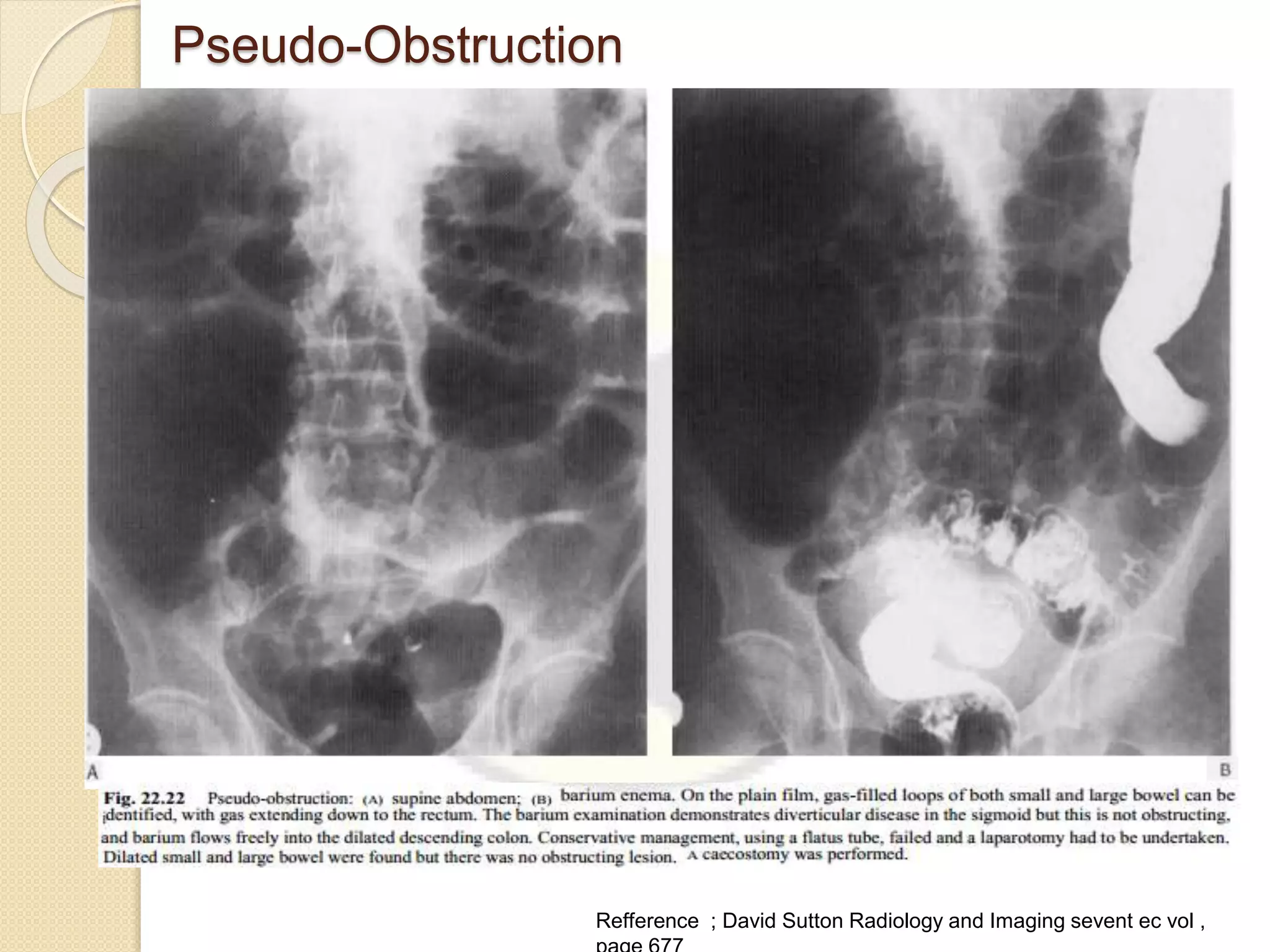 Ileus obstruktif | PPTX