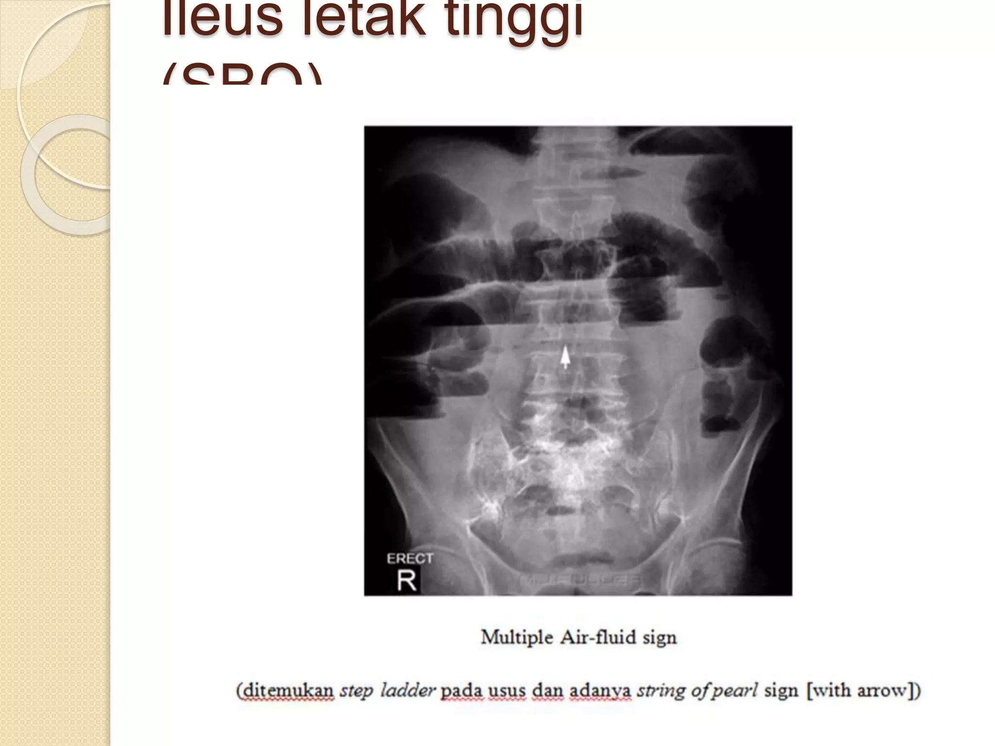 Ileus obstruktif | PPTX