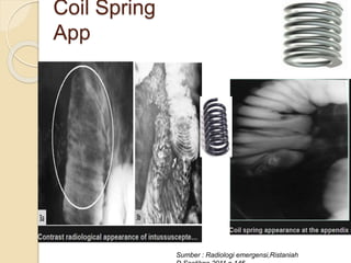 Ileus obstruktif | PPTX