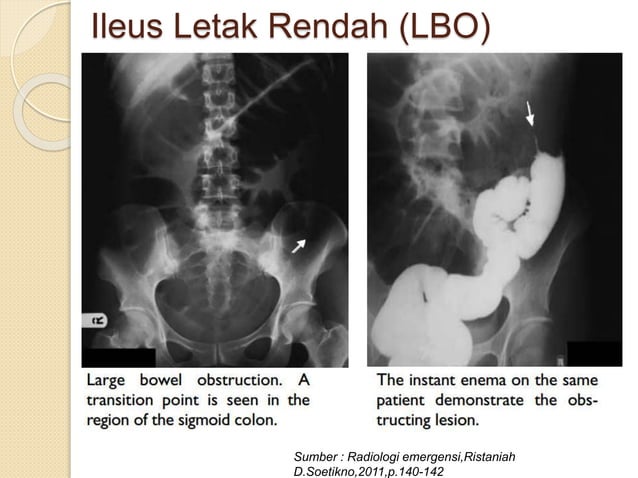 Ileus obstruktif | PPTX