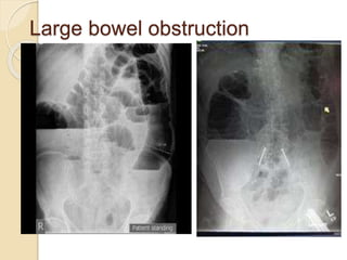 Ileus obstruktif | PPTX