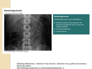 Ileus obstruktif | PPTX