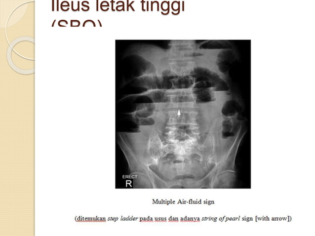 Ileus obstruktif | PPTX