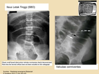 Ileus obstruktif | PPTX