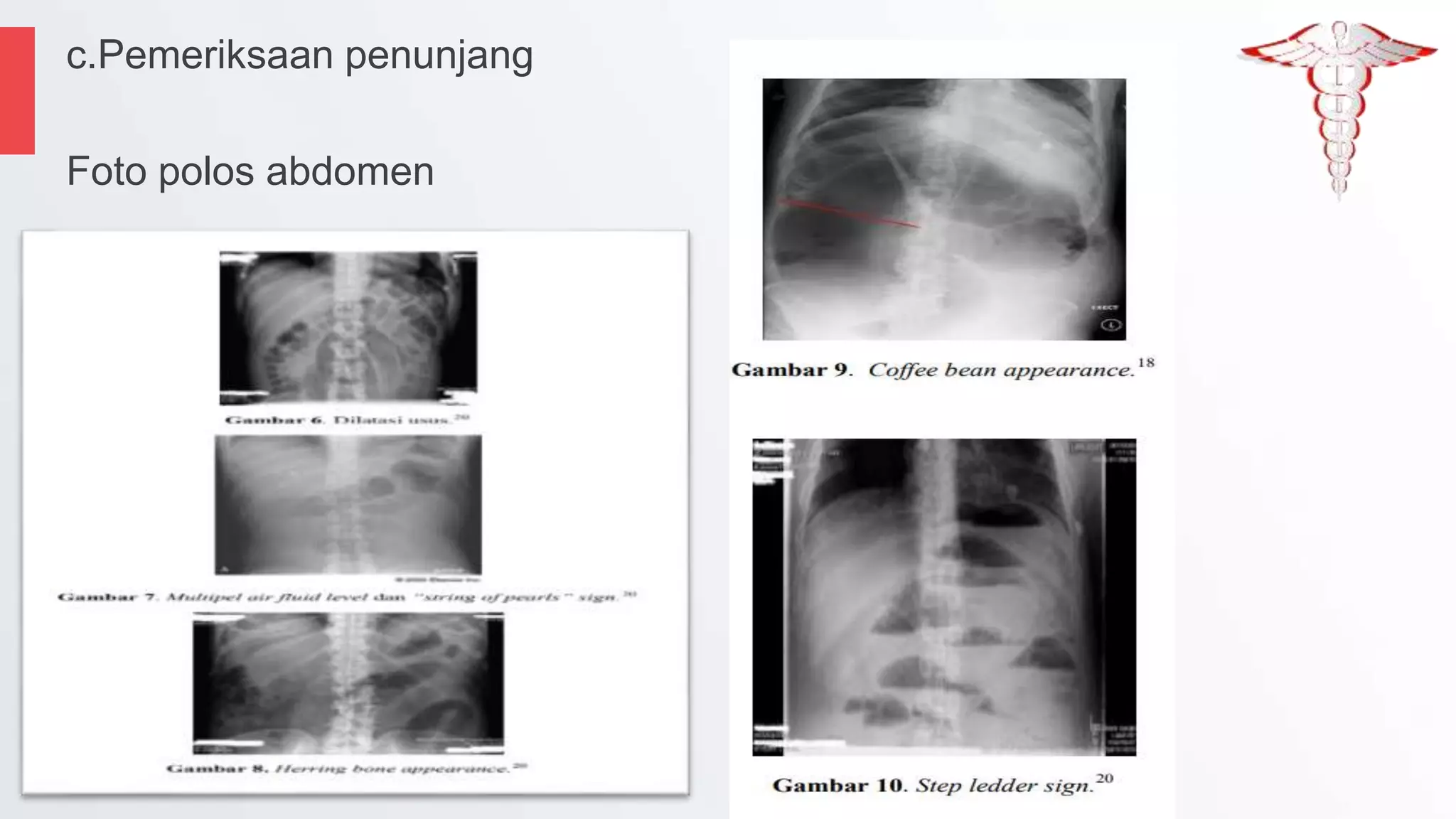 ileus obstruksi.pptx