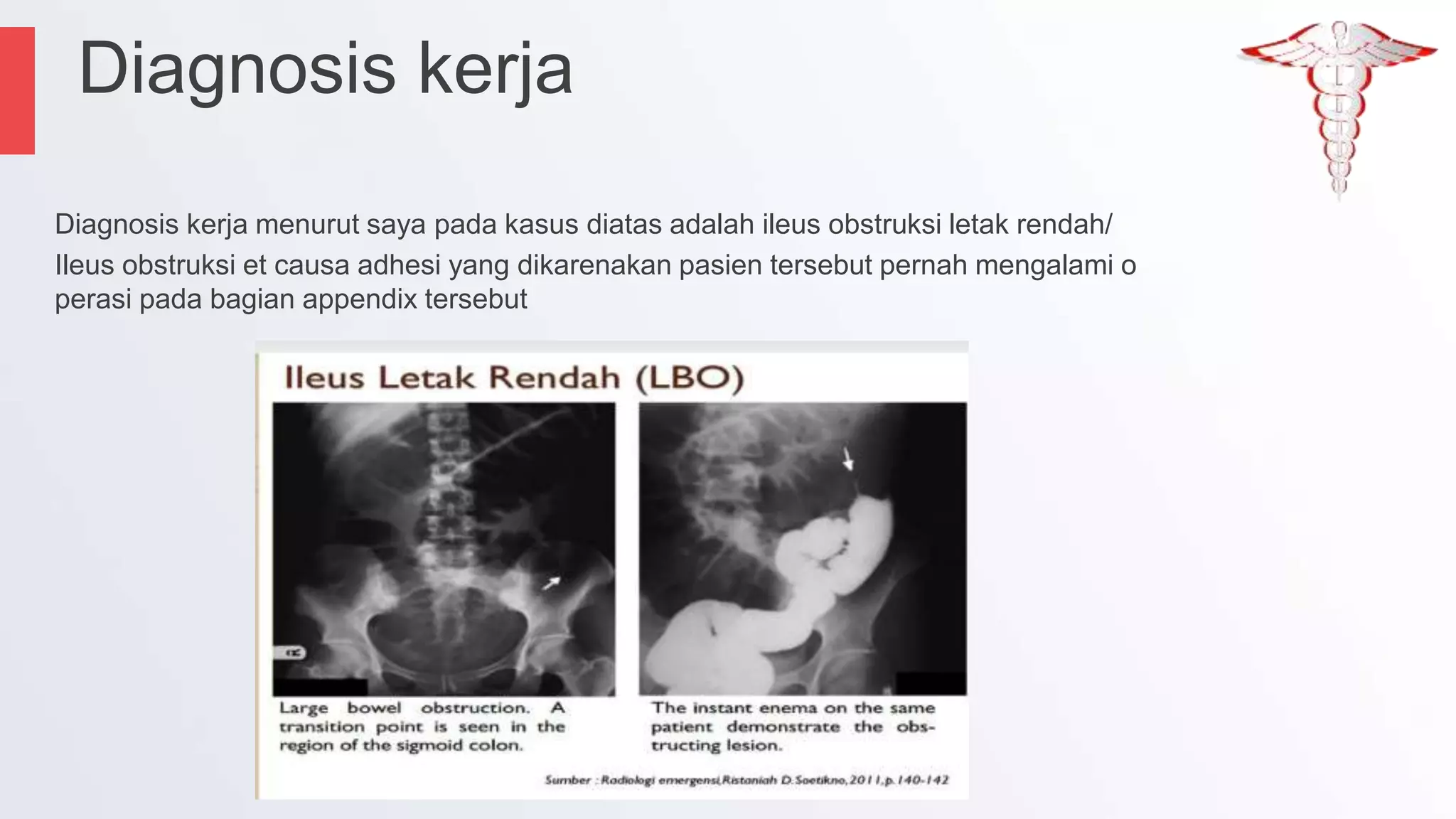 ileus obstruksi.pptx