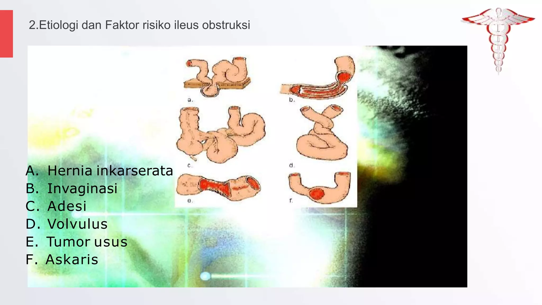 ileus obstruksi.pptx