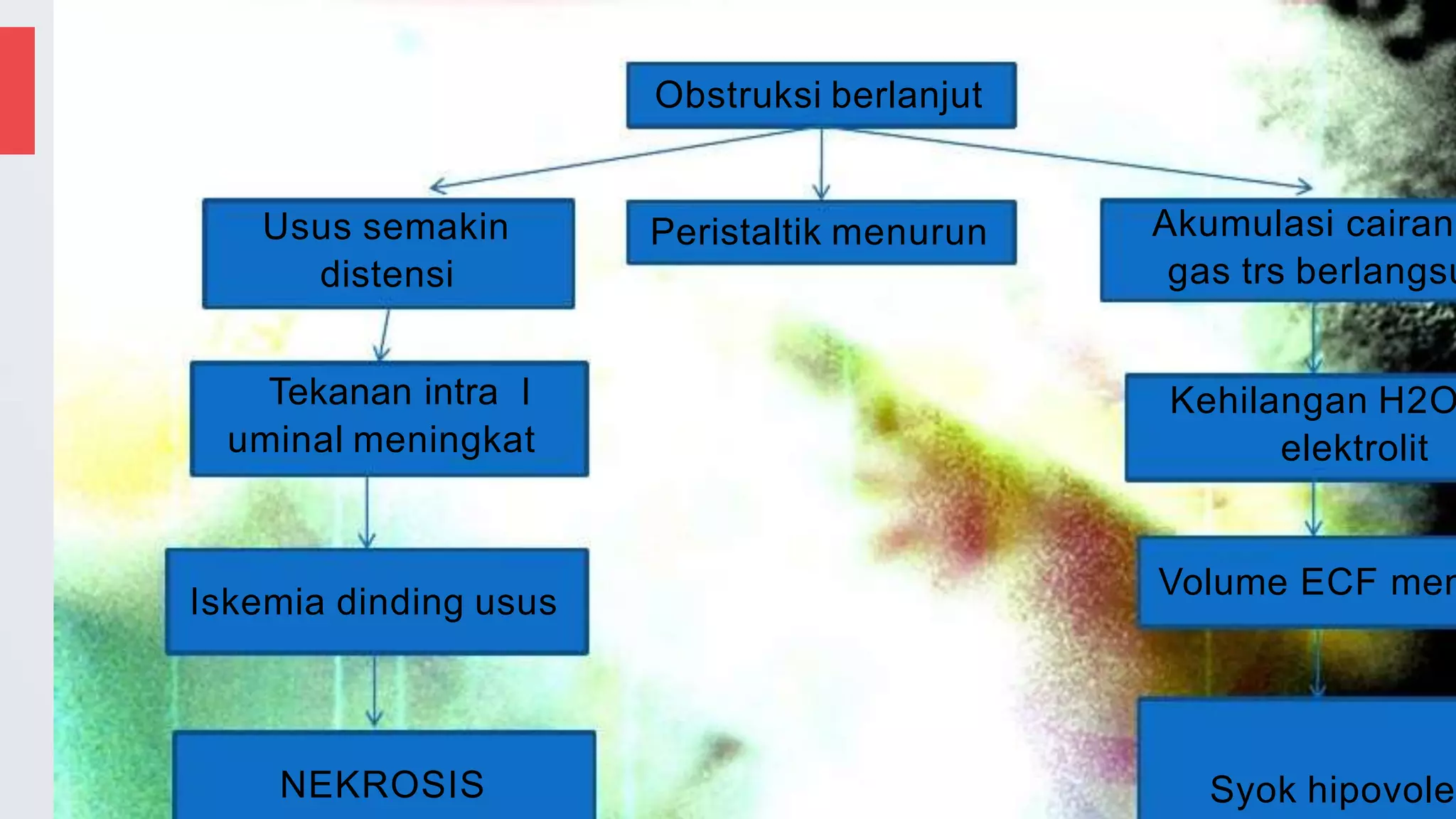 Ileus Obstruksi Pptx