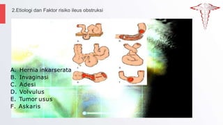 ileus obstruksi.pptx
