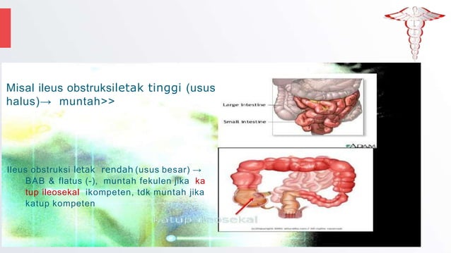 ileus obstruksi.pptx