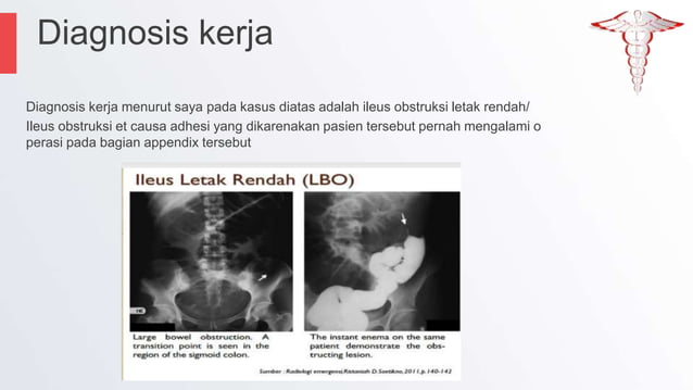 ileus obstruksi.pptx