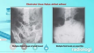 Ileus obstruksi | PPTX
