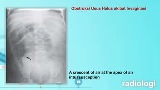 Ileus obstruksi | PPTX