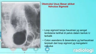 Ileus obstruksi | PPTX