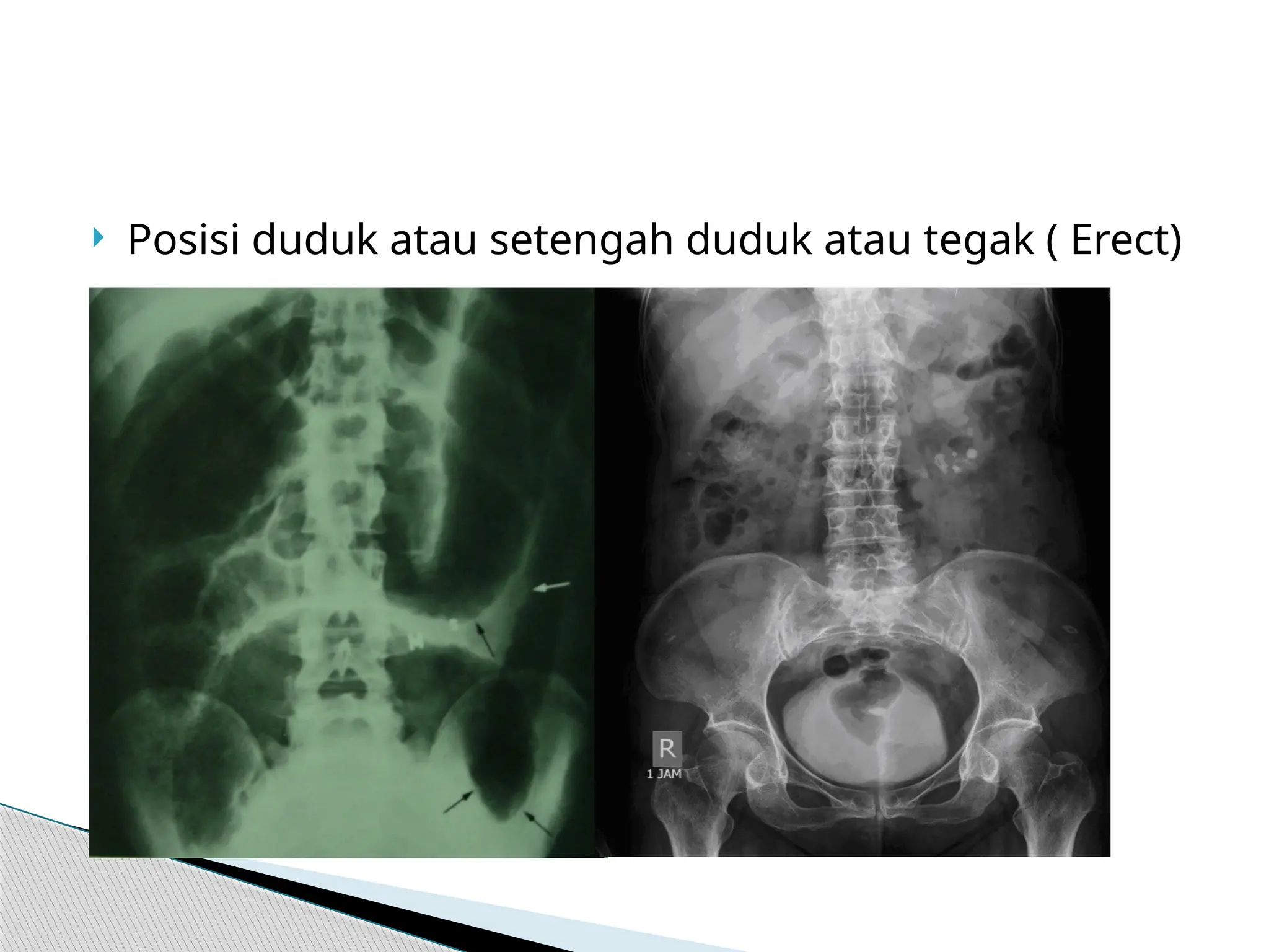 ILEUS OBSTRUKSI UNAYA (1)...........pptx