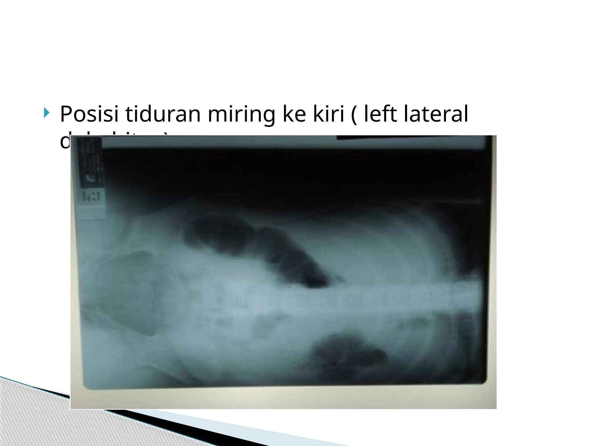 ILEUS OBSTRUKSI UNAYA (1)...........pptx