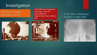 Intra lenticular foreign body | PPTX