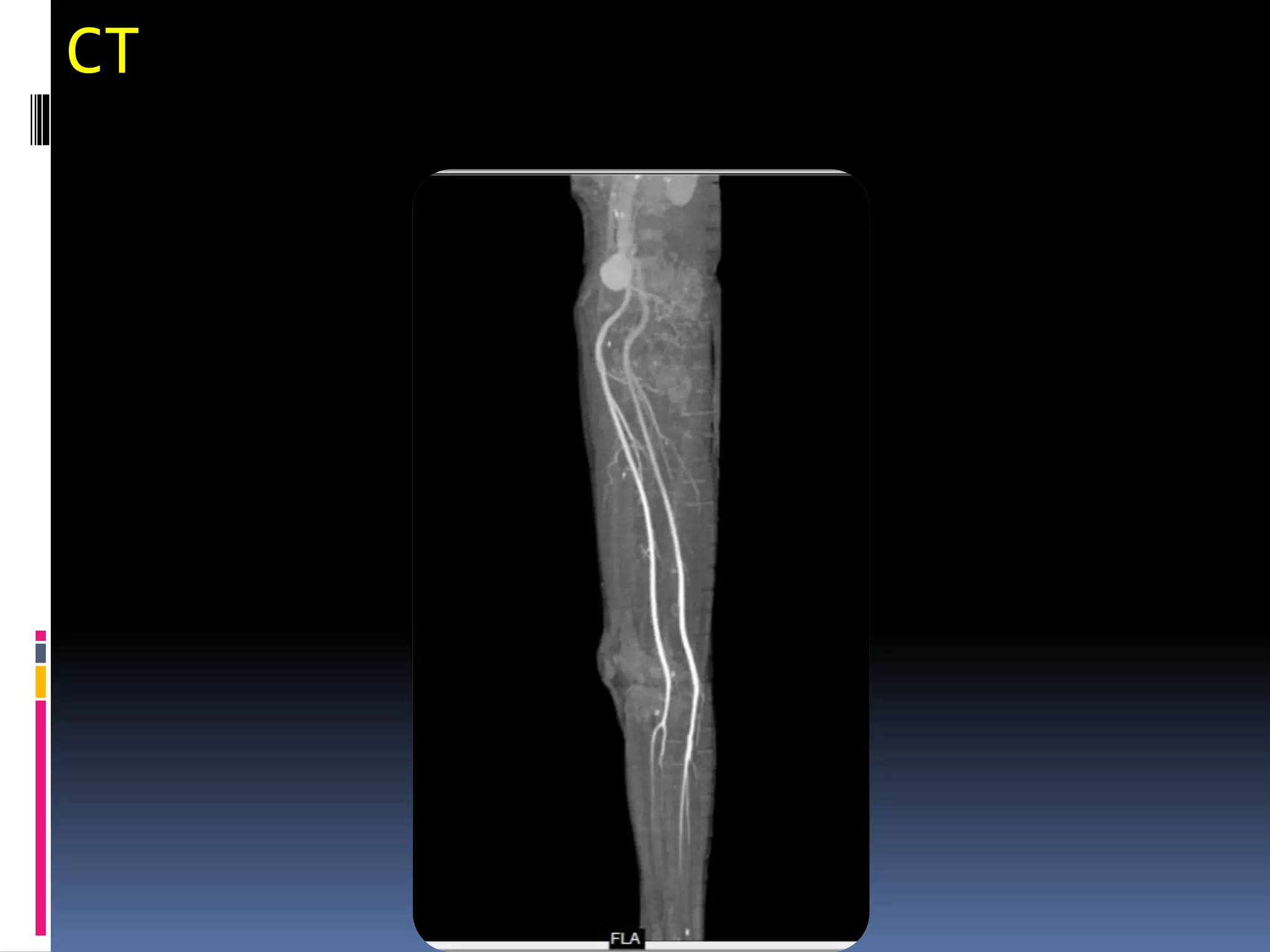 Iliac stenting, aneursym, endovascular stenting | PPTX