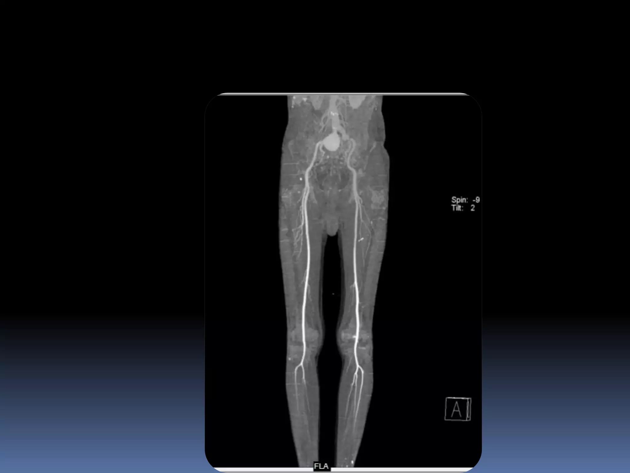 Iliac stenting, aneursym, endovascular stenting | PPTX