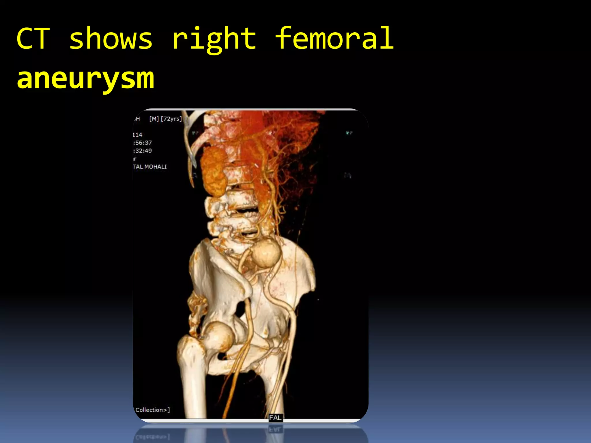 Iliac stenting, aneursym, endovascular stenting | PPTX