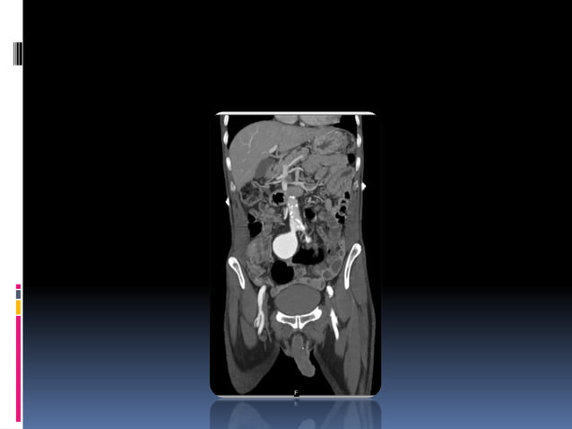 Iliac stenting, aneursym, endovascular stenting | PPTX