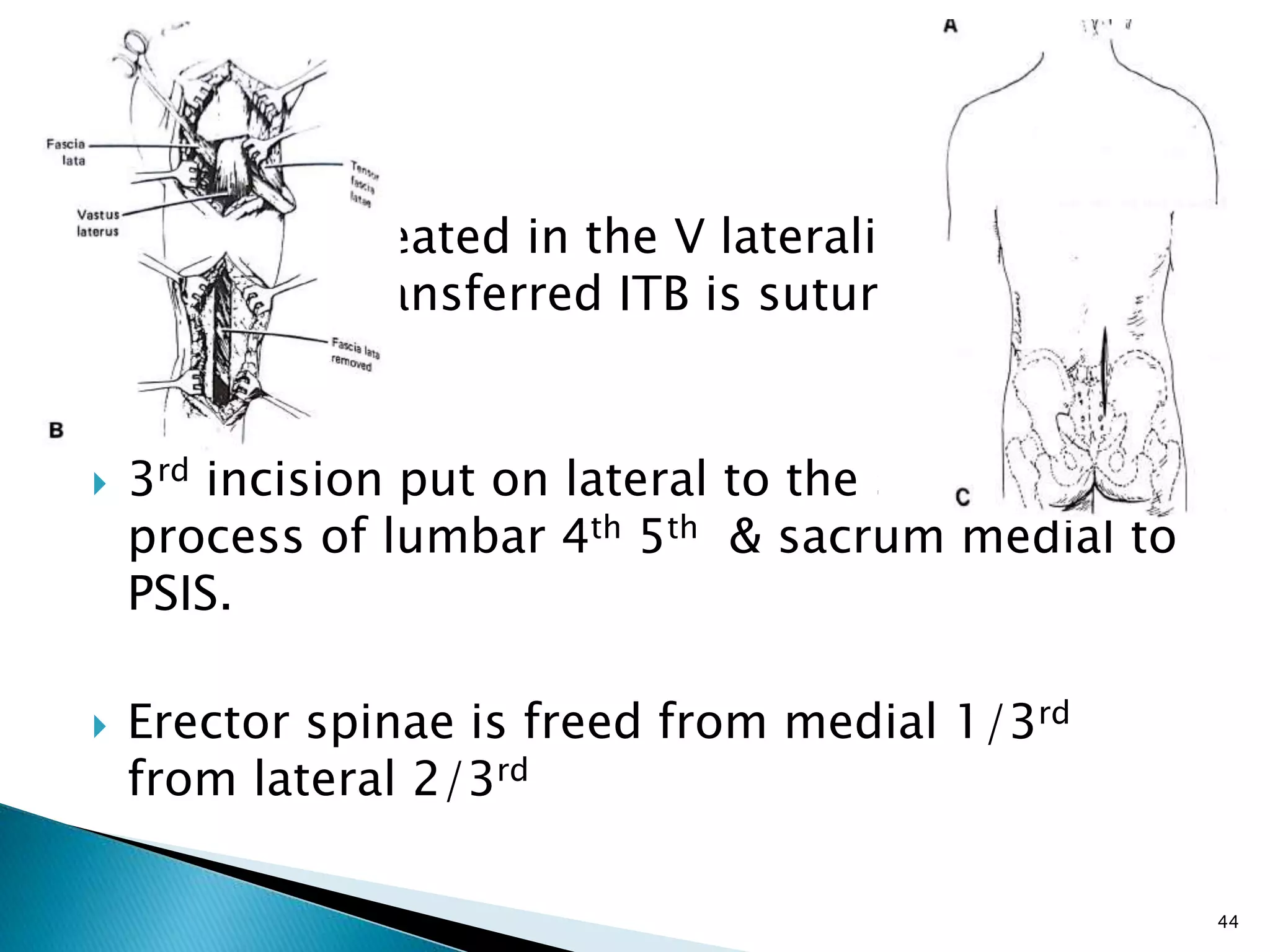 Iliotibial band contracture | PPTX